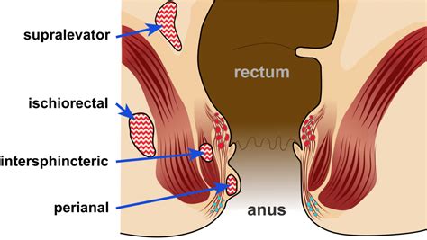 Anorectal Abscess Risk Factors Management Teachmesurgery