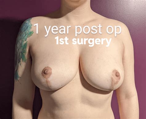 1 Year Post Op 2nd Reduction Out Of 3 Surgeries 32j 32dd R