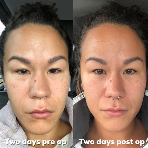 Before And After Breast Augmentation South Africa Mixg