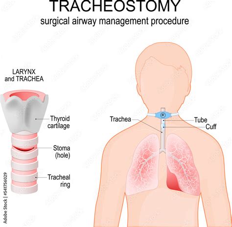 Juliste Tracheostomy Anatomy Of The Trachea With Stoma Larynx