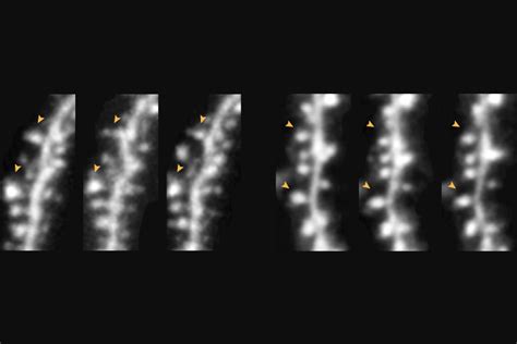 Hippocampal Synaptic Plasticity New Insights Into Fragile X Syndrome