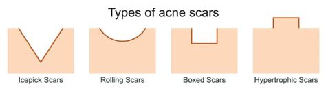 Are Acne Scars Permanent The Truth About Acne Scars Sl Aesthetic Clinic