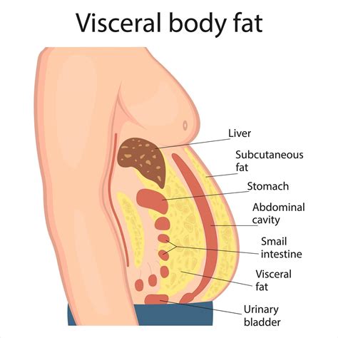 Visceral Fat And Subcutaneous Fat Accumulate Around Organs Medicine
