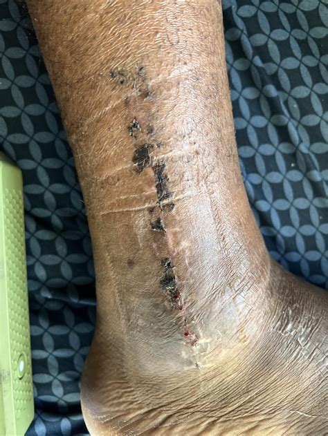 Fractured Tibia And Fibula R Brokenbones