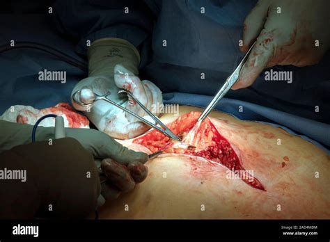 Exploratory Abdominal Surgery Close Up Of A Surgeon Opening The