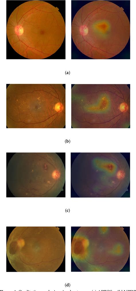 Figure From A Regression Based Approach To Diabetic Retinopathy Diagnosis Using Efficientnet