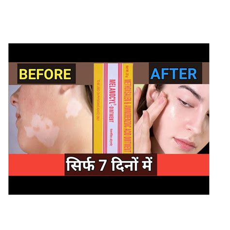 Melanocyl Ointment 25gm