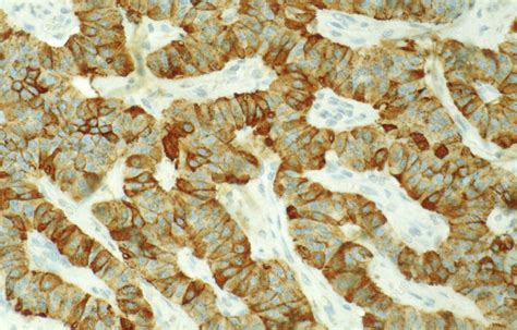 Lung Cancer Light Microscopy Stock Image C0618586 Science Photo