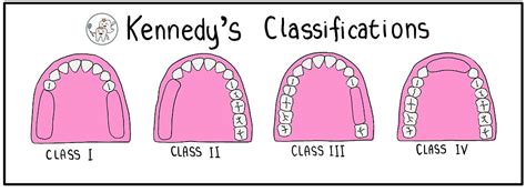What Is Kennedys Classification