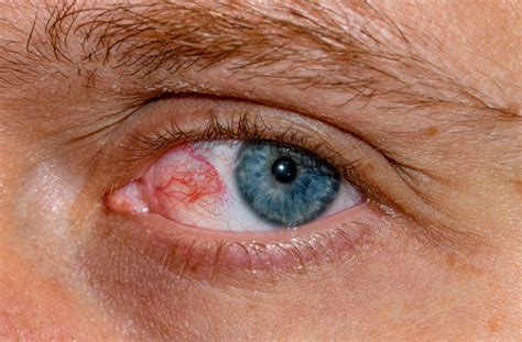 Scleral Hematoma Causes