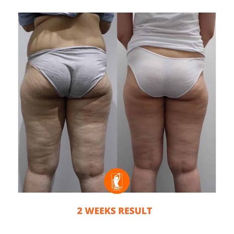 What Causes Cellulite And The Most Effective Cellulite Treatments