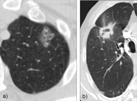 Seudocavitación En Las Neoplasias De Pulmón ¿permite Predecir El