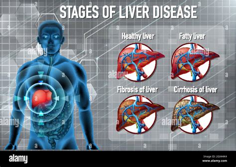 Stages Of Liver Disease Stock Vector Image And Art Alamy
