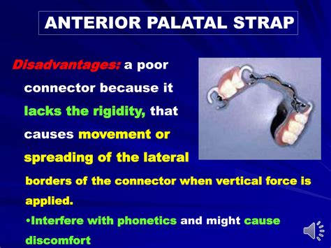 Maxillary Major Connectors Ppt