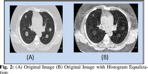 Figure 2 From Lung Cancer Detection And Classification On Ct Scan Images Using Enhanced