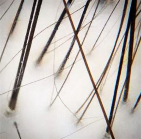Trichoscopy Of Androgenetic Alopecia — Donovan Hair Clinic