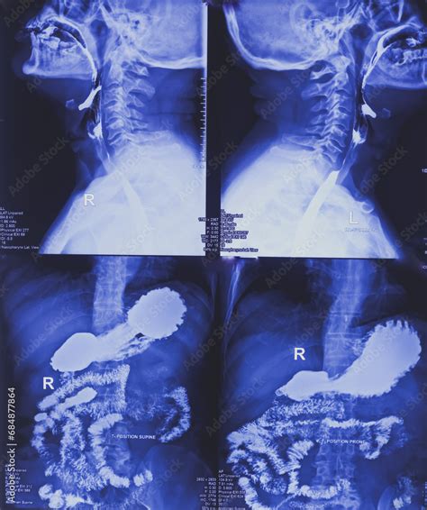 Barium Swallow Of Oesophagus Examination X Ray Showing Upper Digestive