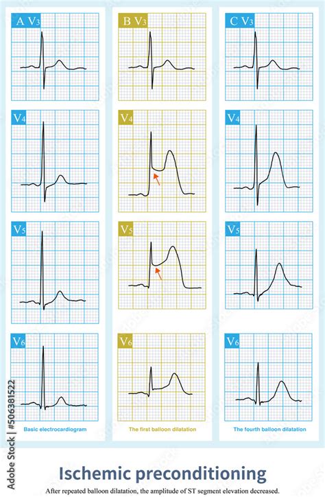 Ischemic Preconditioning Is A Kind Of Myocardial Ischemic Protection After Multiple Transient