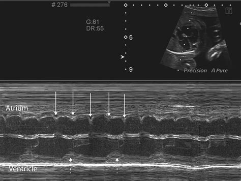 Atrial Flutter In Fetus With Immune‐mediated Complete Heart Block Vigneswaran 2018