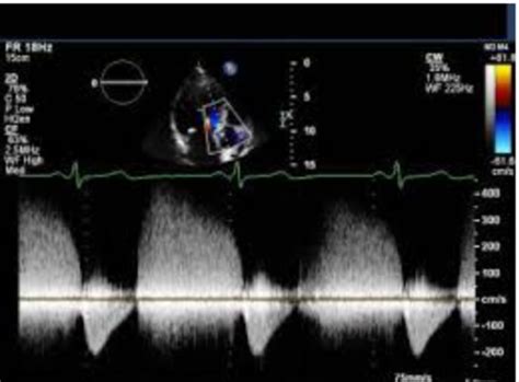 Cci Echo Board Review Flashcards Quizlet