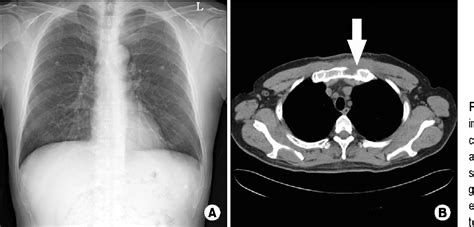 Figure 2 From Primary Sternal Osteomyelitis Caused By Actinomyces