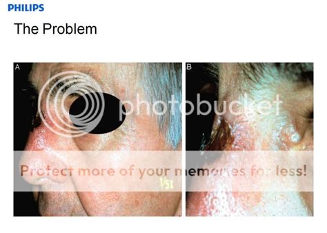 Cpap Basics 18 Complications Of Cpap