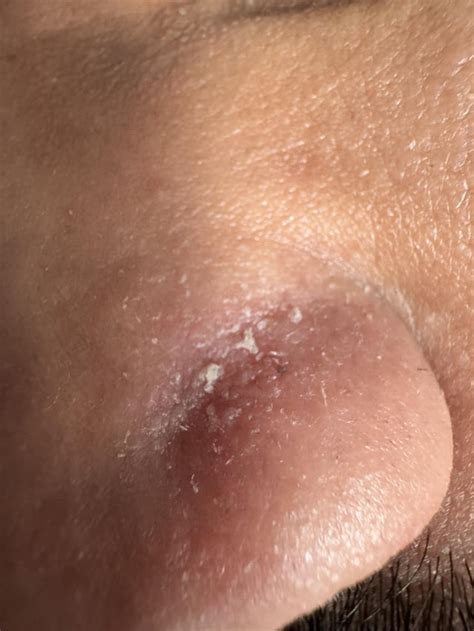 Face Skin Problems R Dermatologyquestions