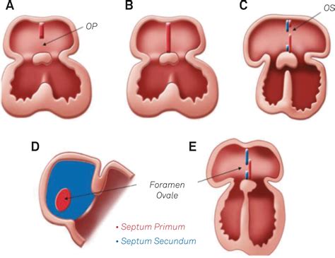 Scielo Brasil Endovascular Closure Of Patent Foramen Ovale A