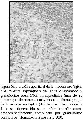 Esofagitis Eosinofílica En Niños Características Clínicas Y Endoscópicas