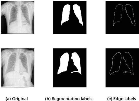 Figure 5 From Automatic Lung Segmentation In Chest X Ray Images Using