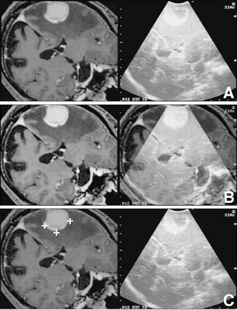 Figure 1 From Evaluation Of Intraoperative Brain Shift Using An