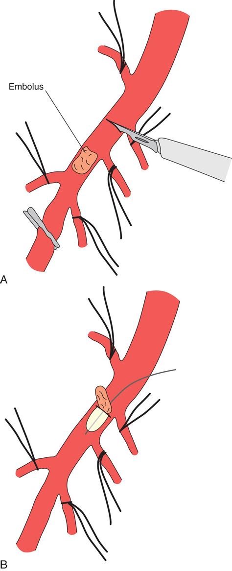 Mesenteric Ischemia Clinical Tree