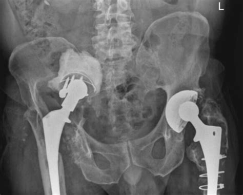 Girdlestone Hofteprocedure En Guide Mednote