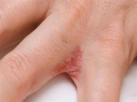 Skin Between Thumb And Index Finger What Causes Itching Swelling