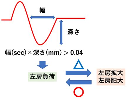 P Terminal Forceとは？ 心電図 Com