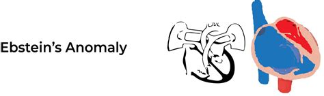 Ebsteins Anomaly ~ Stat Cardiologist