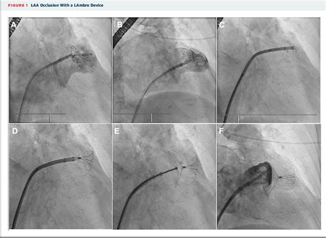 Figure 1 From Percutaneous Closure Of Left Atrial Appendage With Complex Anatomy Using A Lambre