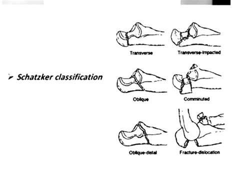 Olecranon Fracture Anatomy Clinical Picture Pptx