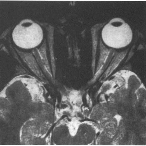 A Os Severe Superior Arcuate Defects In Superior Quadrants With A