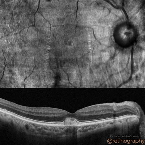 Acquired Vitelliform Lesion Retinography