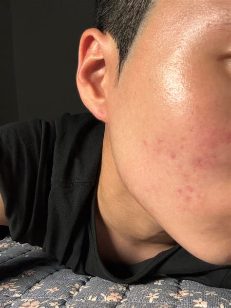 여드름피부 문제 지식in