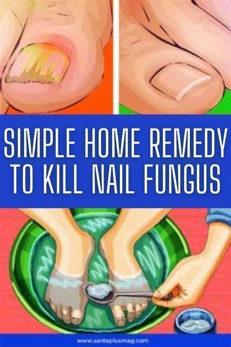 Nail Fungus Activates When You Use This Popular Treatment Artofit