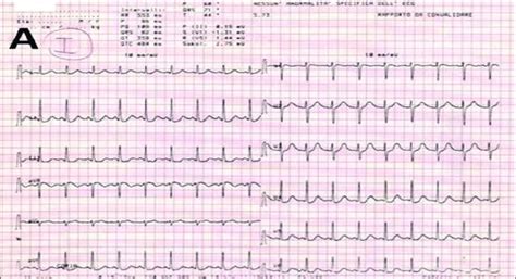 Electrocardiogram Was Suggestive Of Subendocardial Ischemia In Download Scientific Diagram