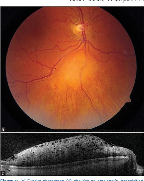 Suspicious Retinal Lesion With A Distinctive Appearance Semantic Scholar