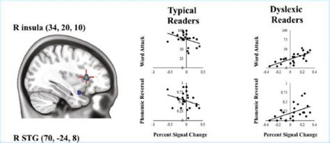 Research Confirms Right Brained Dyslexic Reading Strength Dyslexia