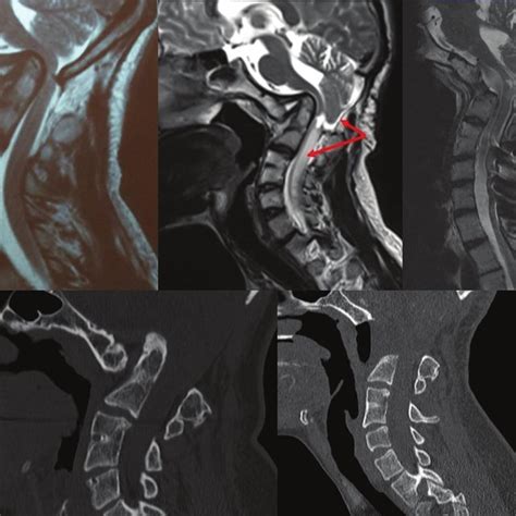 Upper Row Initial Mri Displaying Basilar Invagination With Lower