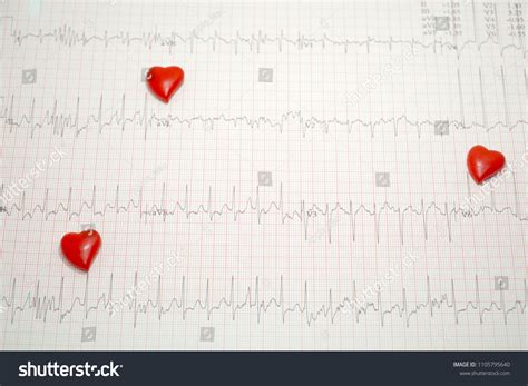 Elektrokardiogram Electrocardiogram Ekgecg Paper Form Little Foto De