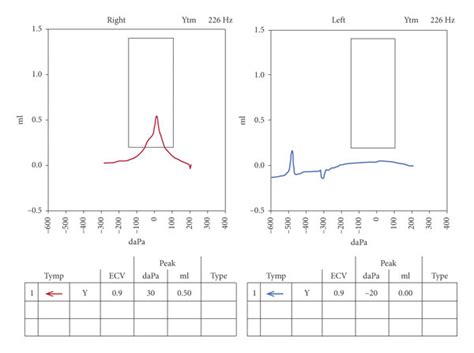 Tympanogram Showing Type A For The Right Ear And Type B For The Left