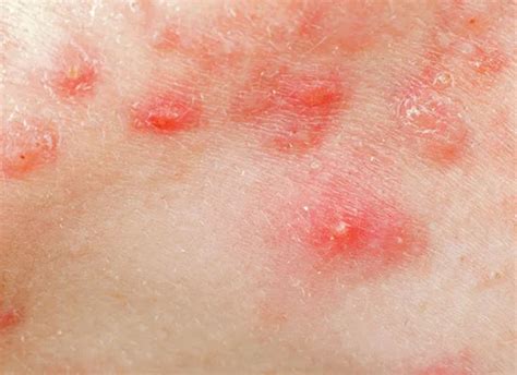 Nodular Acne Images And Pictures Photo Gallery Of Skin Pictures