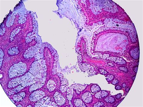 Sayed Attar On Linkedin Sigmoid Colon Hyperplastic Polyp In A 25 Y Lady